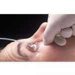 The Morgan Lens - Emergency Care, Emergency Eyecare - Albert Waeschle