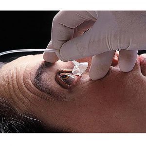 The Morgan Lens - Emergency Care, Emergency Eyecare - Albert Waeschle